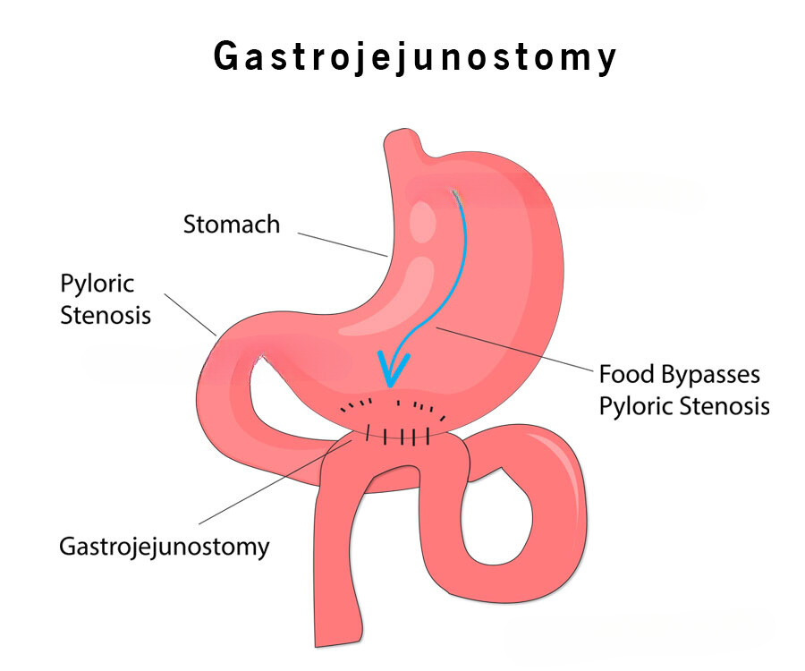 Gastrpintestinal Surgery In Noida Curis Multispeciality Gastrpintestinal Surgery In Noida Curis Multispeciality